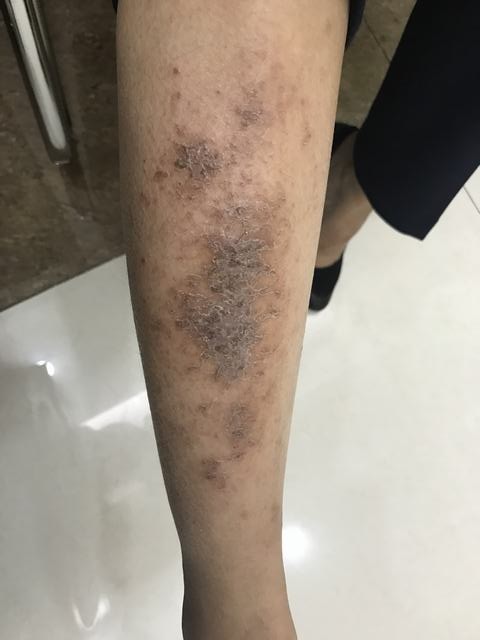 Bệnh Sán Chó Dấu Hiệu Nhận Biết Và Thời Gian Trị Bệnh Sán Chó