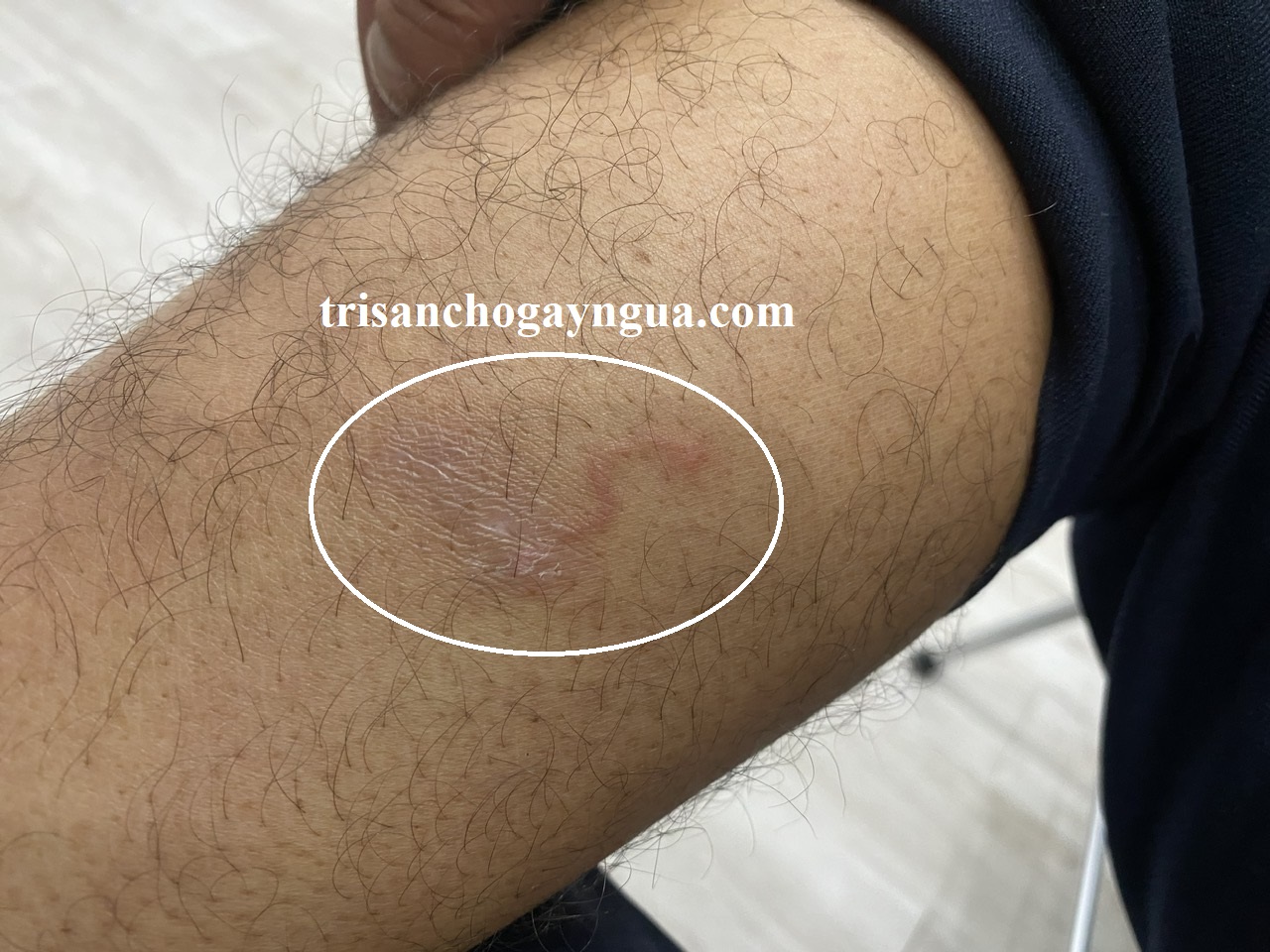 Bệnh Giun Móc Ancylostoma: Nguyên Nhân Lây Nhiễm, Triệu Chứng Và Cách ...