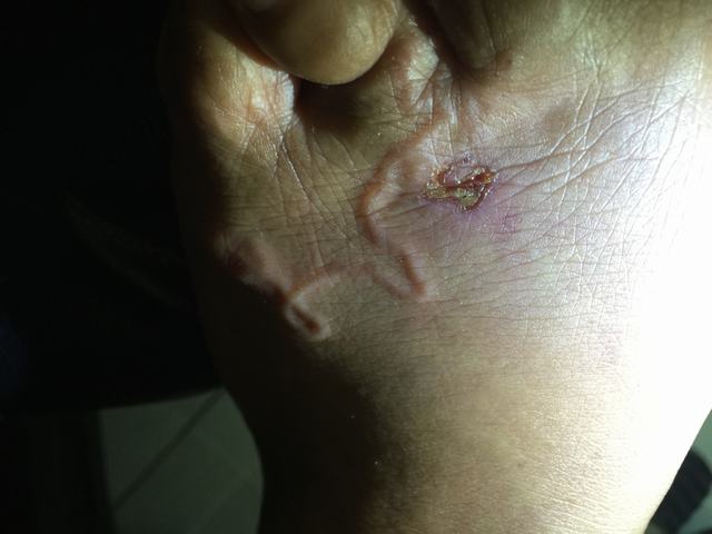 Sán Chó Ở Người Cách Phát Hiện Và Thời Gian Trị Sán Chó Ở Người Bao Lâu